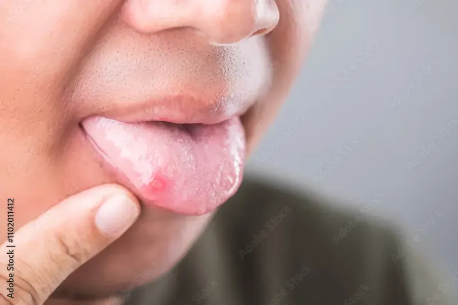Effective Home Remedies for Tongue Ulcers and Mouth Sores